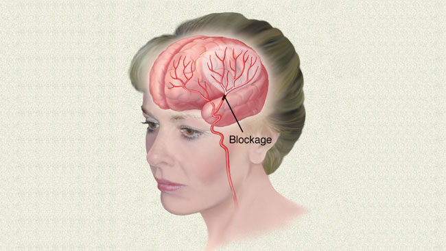 Stroke Treatment Today